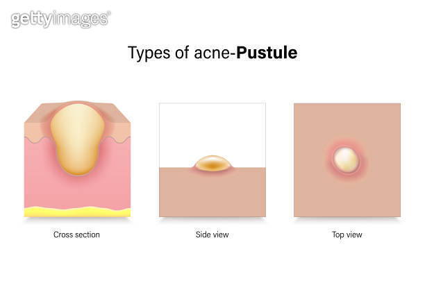 Types of acne. Skin problems. Pustule in cross section, side view and ...