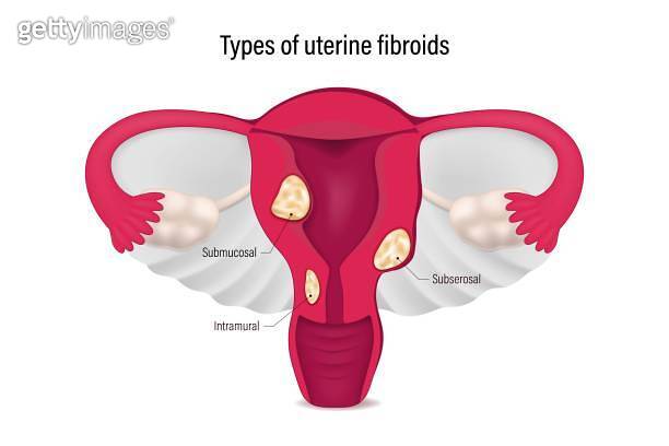 Types of uterine fibroids. Submucosal, Subserosal and Intramural ...