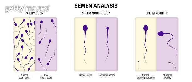 Semen analysis. Sperm count, morphology and motility. Male sperm ...