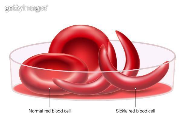 Sickle cell disease vector. Sickle cell anemia. Normal and sickle ...