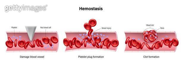 Hemostasis vector. Wound Healing Process Stages. Blood clotting. 이미지 ...