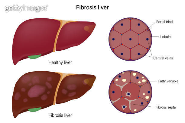 Liver histology. Normal liver and fibrosis liver. Liver disease for ...