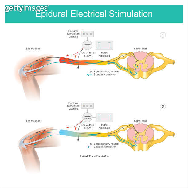 Epidural Electrical Stimulation. Muscle pain symptom in the leg area ...