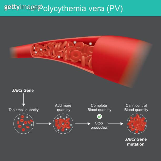 Polycythemia vera. Too much red blood cells have in blood vessel and ...