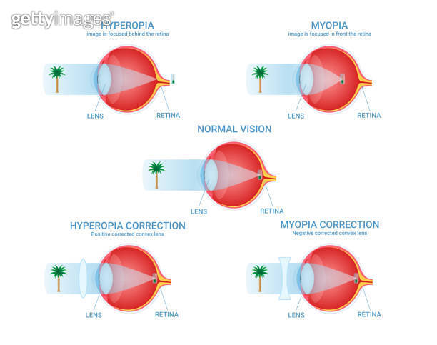Vision defects visual impairment normal myopia hyperopia correction ...