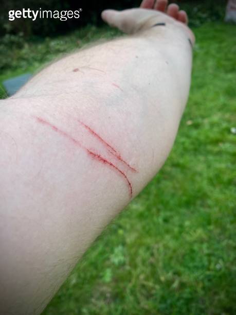 Large scratch/cut on arm from brambles in garden. 이미지 (1728425497) - 게티 ...
