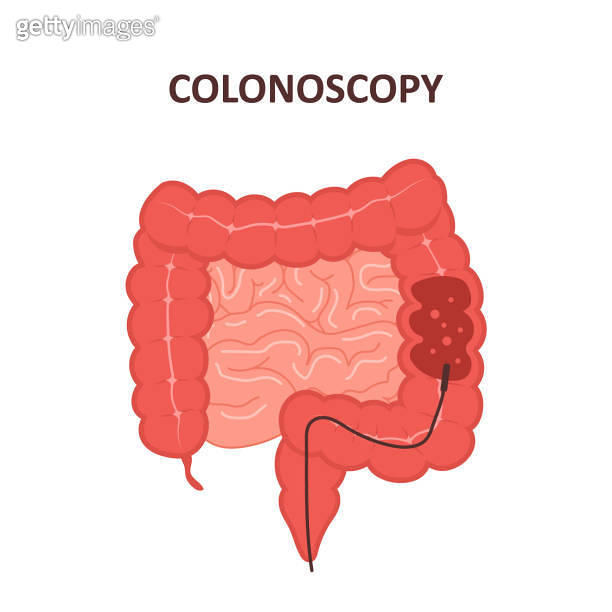 Colonoscopy procedure. Intestine exam and treatment. Colon polypectomy ...