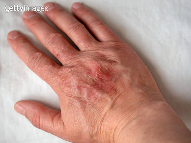 Thermal burn of the skin of the hand close-up. Healing wound, injury ...