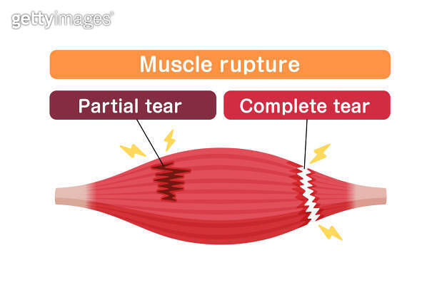 Muscle rupture vector illustration (partial and complete tears ) 이미지 ...