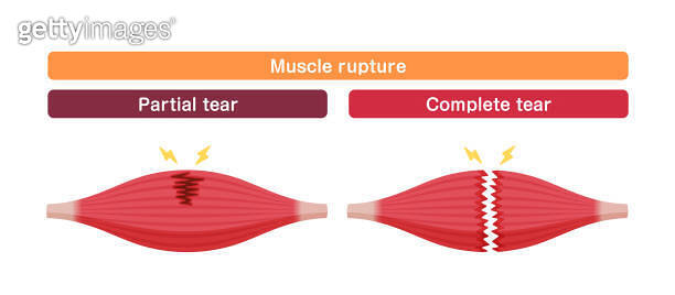 Muscle rupture vector illustration (partial and complete tears ) 이미지 ...