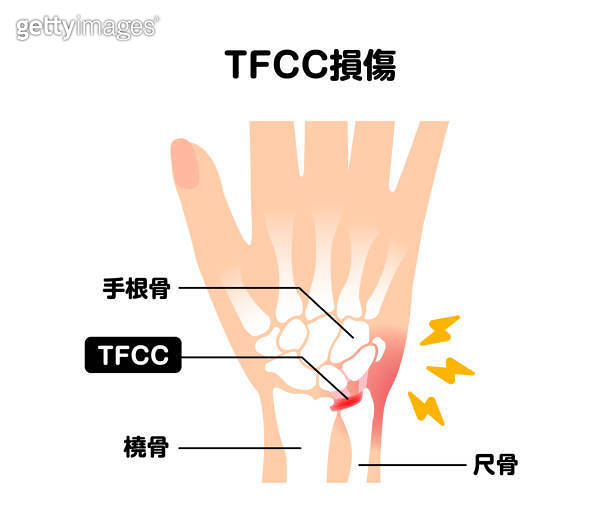 TFCC injury Vector illustration 이미지 (1483182631) - 게티이미지뱅크