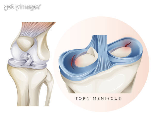 Knee Cartilage Injury - Torn Meniscus - Stock Illustration 이미지 ...
