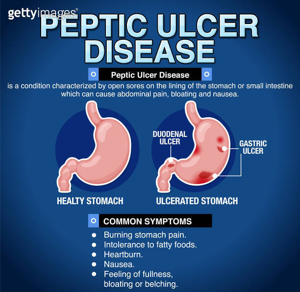 Peptic Ulcer Disease Explained Infographic 이미지 (1473108864) - 게티이미지뱅크