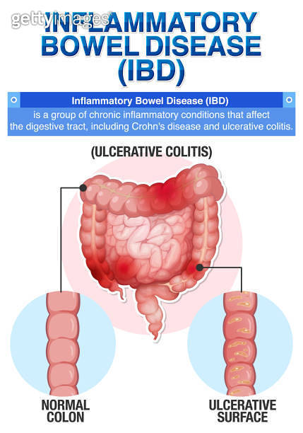 Inflammatory Bowel Disease (IBD) Infographic 이미지 (1471805357) - 게티이미지뱅크