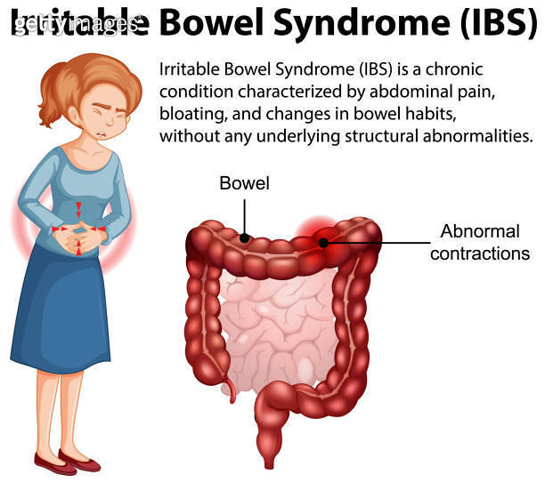 Irritable Bowel Syndrome (IBS) Infographic 이미지 (1471805365) - 게티이미지뱅크