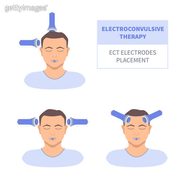 ECT electroconvulsive therapy for severe depression treatment 이미지 ...