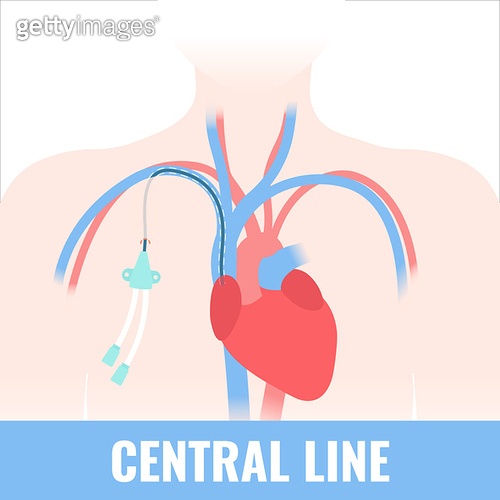 Tunneled central line venous catheter medical diagram (1465580610) - 게티 ...
