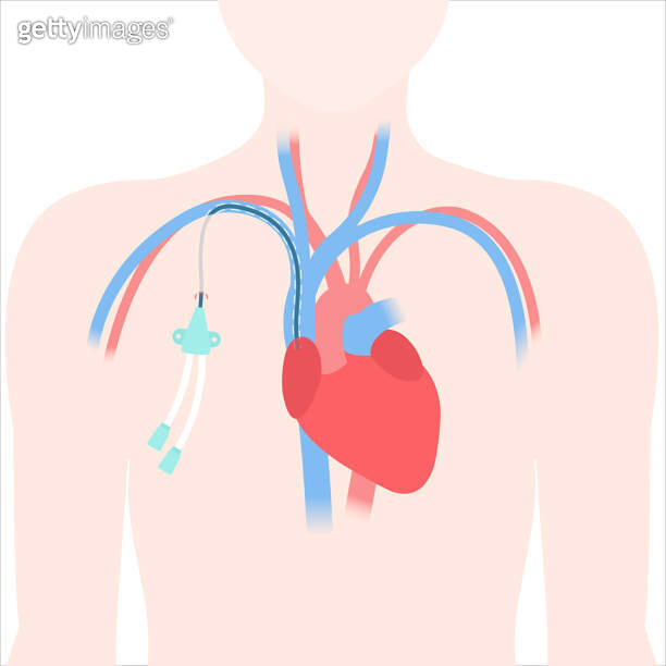 Tunneled central line venous catheter medical diagram (1455735025) - 게티 ...