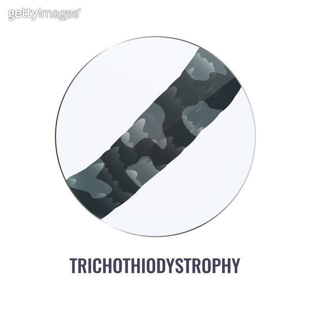 Trichothiodystrophy hair brittle disorder in close up 이미지 (1778103048 ...
