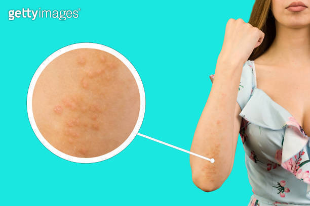 Macro detailed circles magnification psoriasis arm skin with different ...