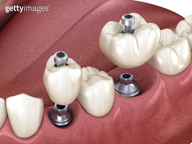 Premolar and Molar tooth crown installation over implant, screw ...