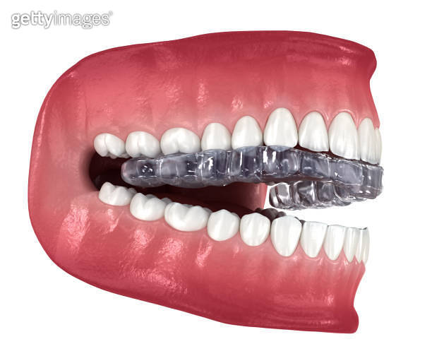 Bite Splint - bruxism protection. Medically accurate dental 3D ...