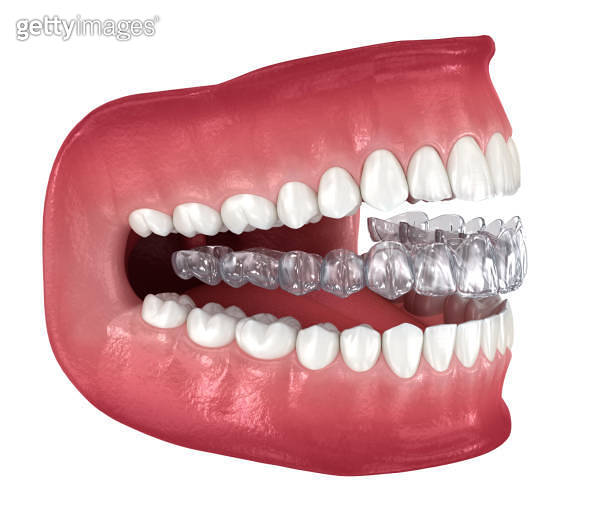 Invisalign braces or invisible retainer. Medically accurate dental 3D ...
