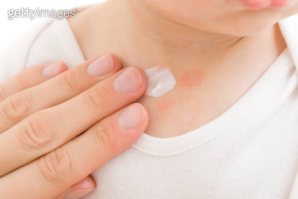 Mother fingers applying white medical ointment on infant body. Red rash ...