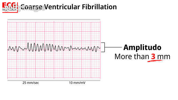 ECG Coarse Ventricular Fibrillation - Electrocardiogram Study Guide ...