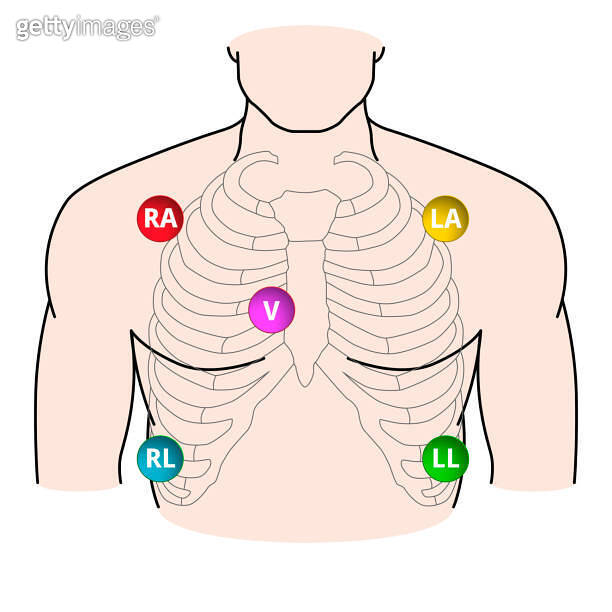 5 Lead Electrode Placement Electrocardiogram - RA, LA, RL, LL, V ...