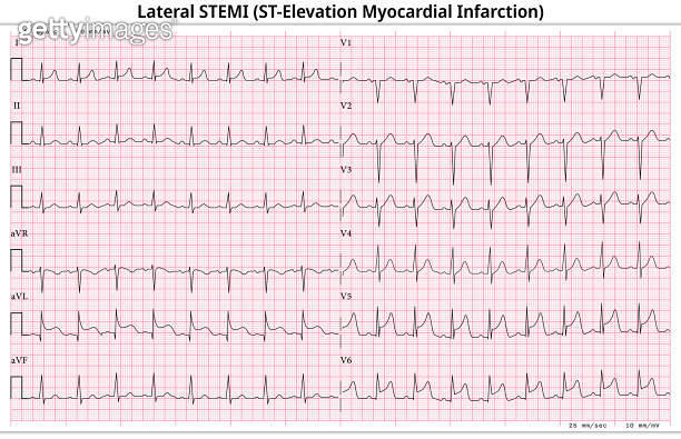 Lateral ST-Elevation Myocardial Infarction (STEMI) - 12 Lead ECG Common ...