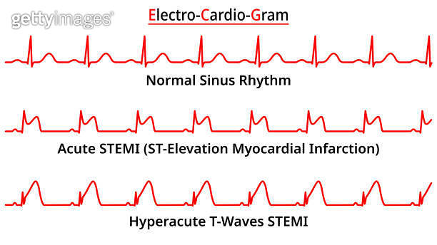 Set of ECG Common Abnormalities - Acute - Hyperacute STEMI (ST ...