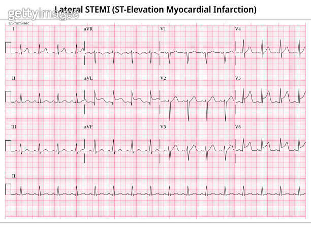 Lateral ST-Elevation Myocardial Infarction (STEMI) - 12 Lead ECG Common ...
