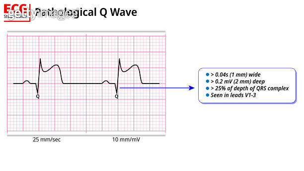 Pathological Q Waves Criteria - ECG Education with Study Guide 이미지 ...