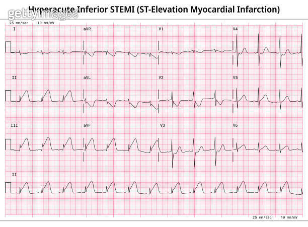 Hyperacute Inferior STEMI (ST-Elevation Myocardial Infarction) - 12 ...