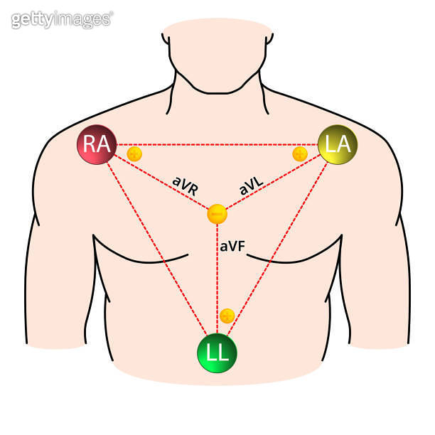 Augmented Limb Leads ECG - Einthoven Triangle - Electrocardiogram ...