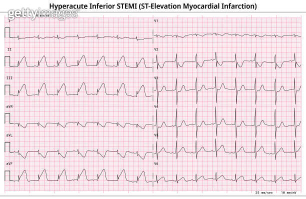 Hyperacute Inferior STEMI (ST-Elevation Myocardial Infarction) - 12 ...