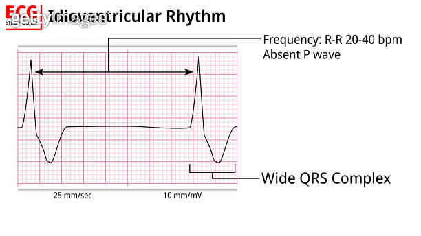 ECG Idioventricular Rhythm - Electrocardiogram Study Guide (1501930758 ...