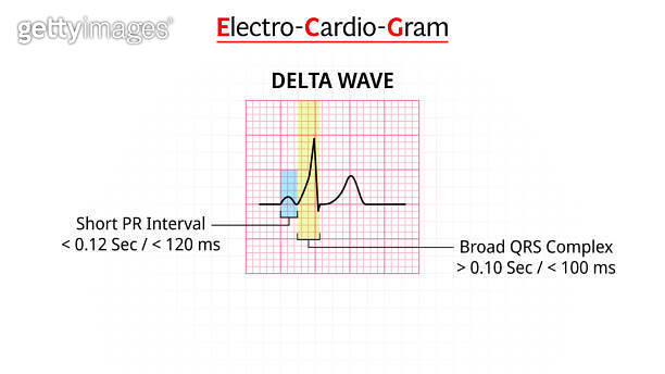 Delta Wave - ECG Morphology - Electrocardiogram 이미지 (1478865201) - 게티이미지뱅크