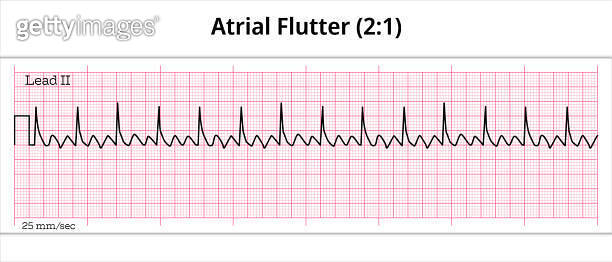 ECG Atrial Flutter (2:1) - 8 Second Electrocardiogram Paper - Vectors ...