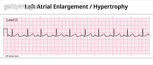 ECG Left Atrial Hypertrophy (LAH) - Left Atrial Enlargement (LAE) - 8 ...