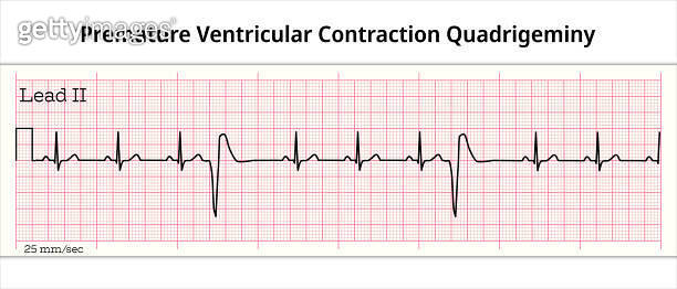 Quadrigeminy Premature Ventricular Contractions (PVCs) - Ventricular ...