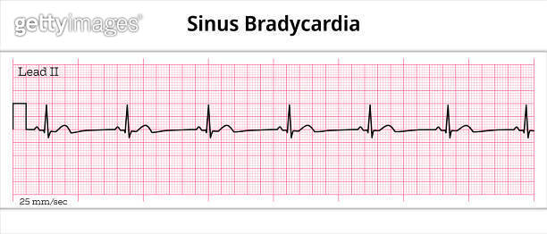 Sinus Bradycardia ECG - 8 Second ECG Paper 이미지 (1486695862) - 게티이미지뱅크