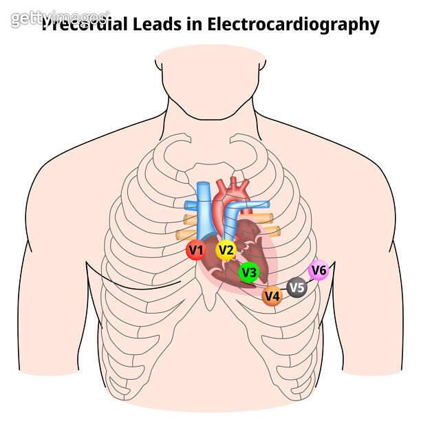 Precordial Leads in Electrocardiography - V1, V2, V3, V4, V5, and V6 ...
