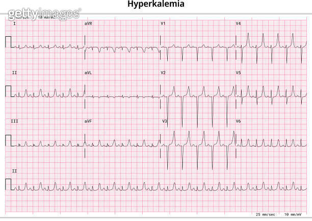 ECG Hyperkalemia - Hyperkalaemia - 12 Lead ECG Common Case - 3 Sec/lead ...