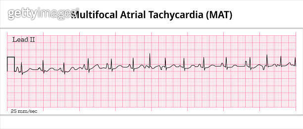 Multifocal Atrial Tachycardia (MAT) - 8 Second ECG Paper (1473001117 ...