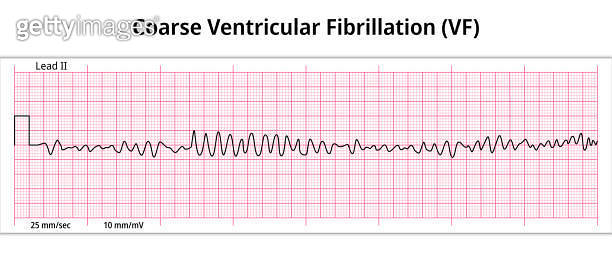 ECG Coarse Ventricular Fibrillation - 8 Second ECG Paper ...