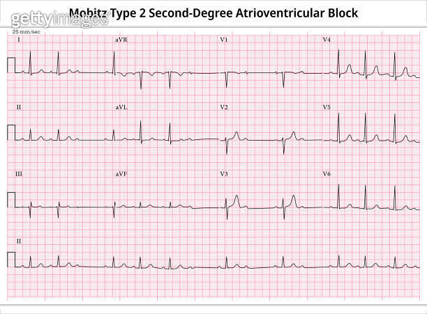 Mobitz Type 2 Second Degree Atrioventricular Block - ECG Paper 12 Lead ...