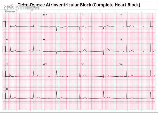 Mobitz Type 2 Second Degree Atrioventricular Block - ECG Paper 12 Lead ...
