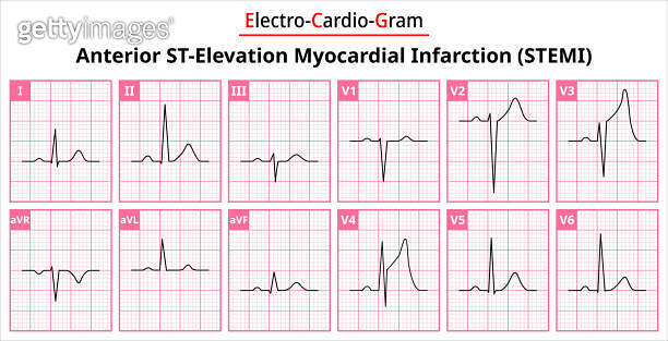 Anterior STEMI (ST-Elevation Myocardial Infarction) - The Differences ...